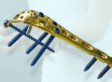 Orthopedic Implants Manufacturers & Suppliers | Top Orthopedic Implants ...